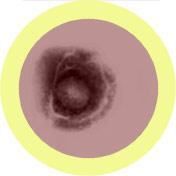 Chickenpox (Varicella-Zoster virus)