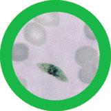 Malaria (Plasmodium falciparum)