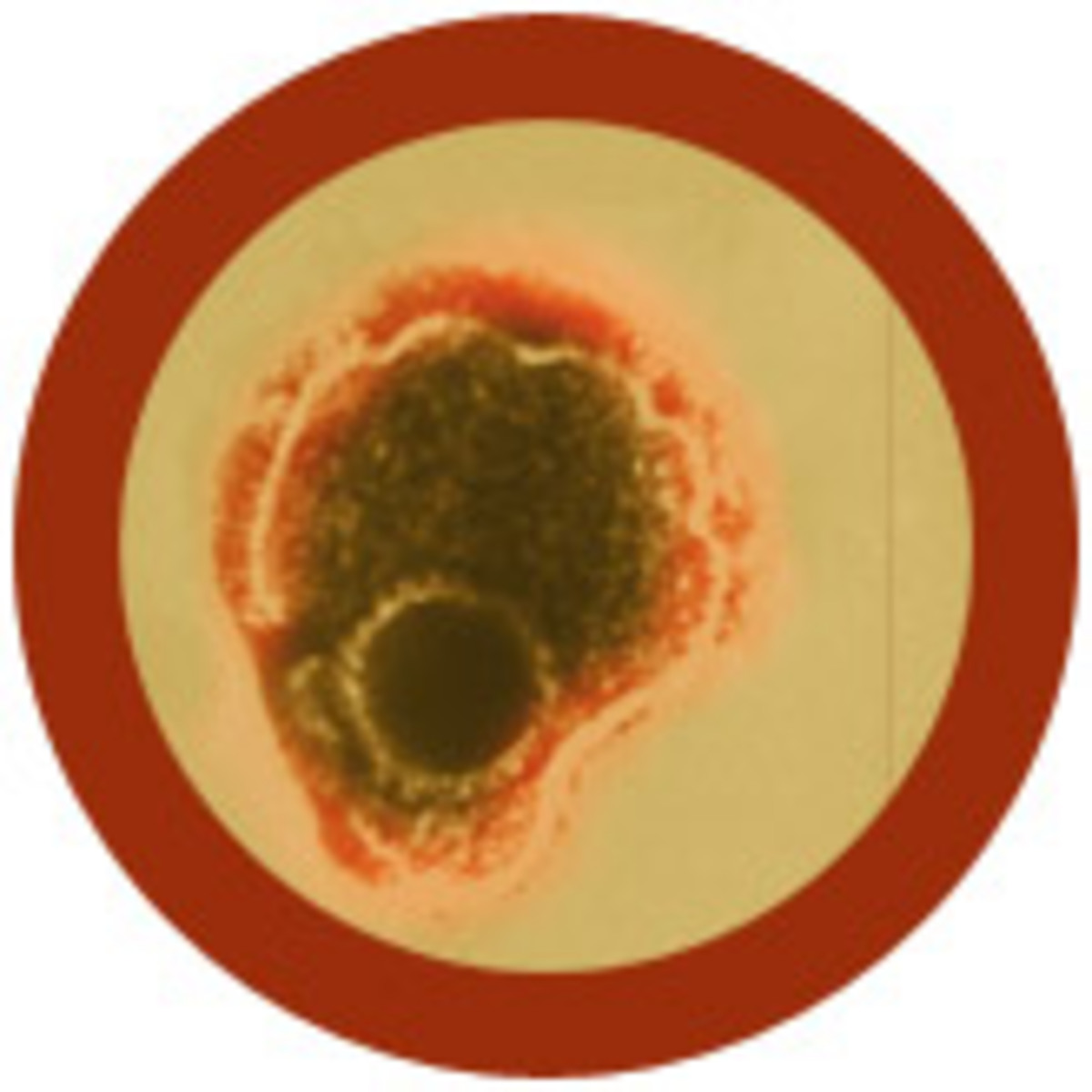 Shingles (Herpes zoster)