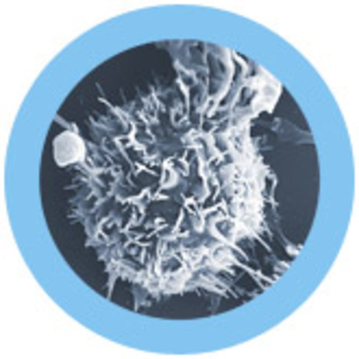 Prostate Cancer (Malignant neoplasm)